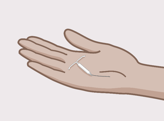 Het hormoon-spiraaltje: voor- en nadelen van het hormonaal spiraal…